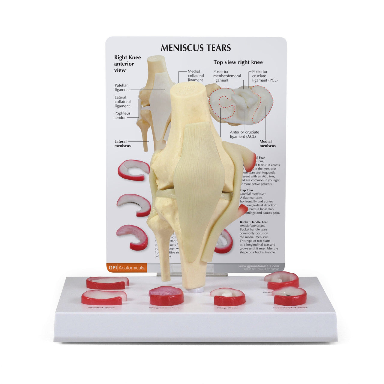 Meniscus Tears Model 1010 | Knee Injury Anatomy | GPI Anatomicals ...