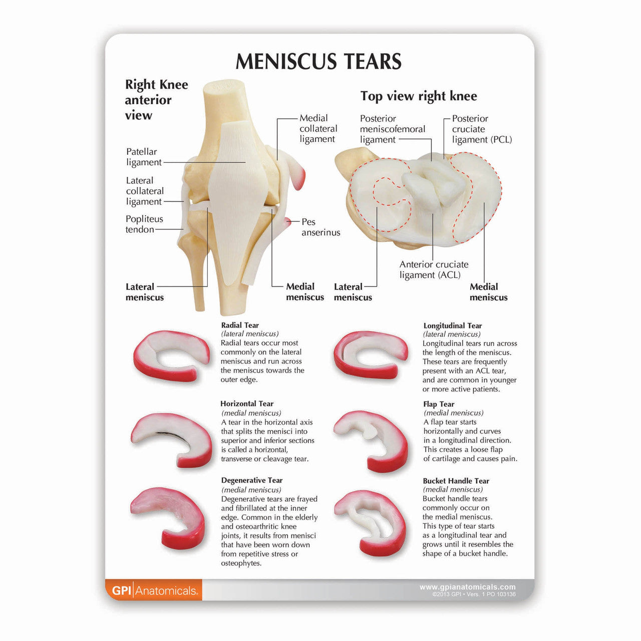Meniscus Tears Model 1010 | Knee Injury Anatomy | GPI Anatomicals ...