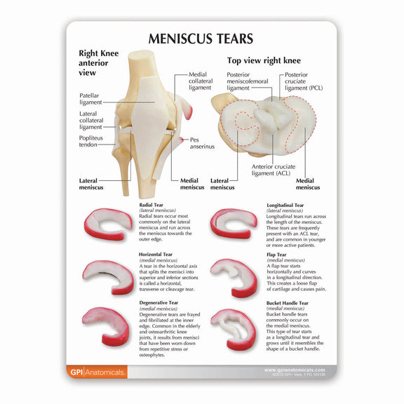 Meniscus Tears Model 1010 | Knee Injury Anatomy | GPI Anatomicals ...