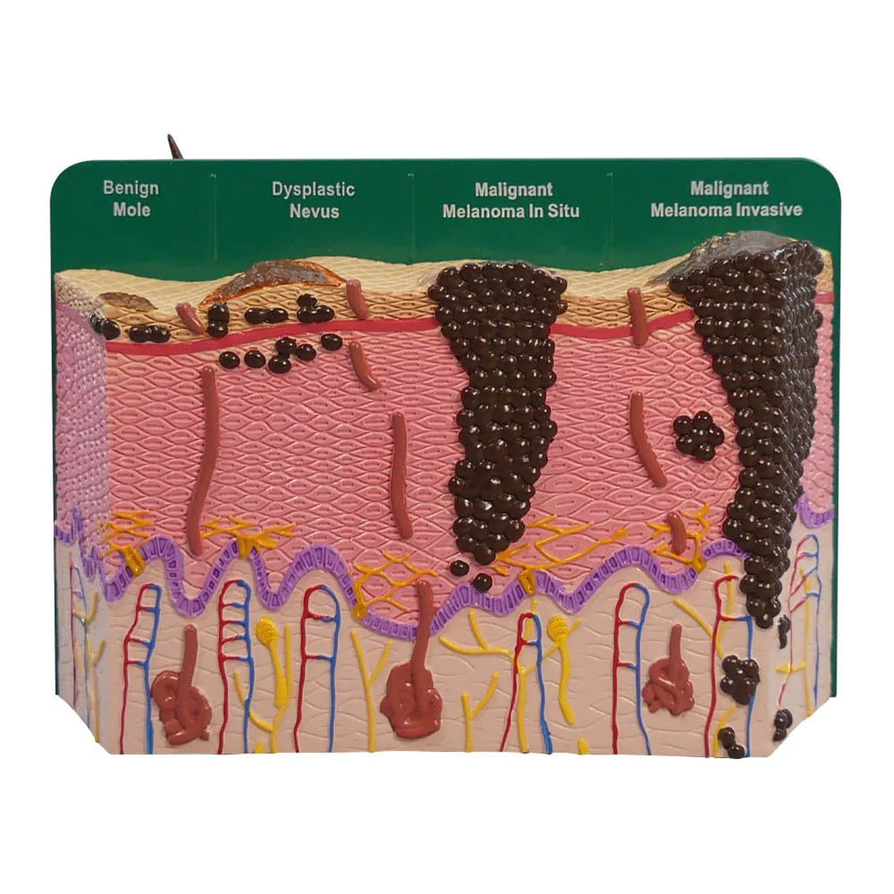 Skin Cancer Model | Dermatology Pathology Chart Model | AnatomyStuff