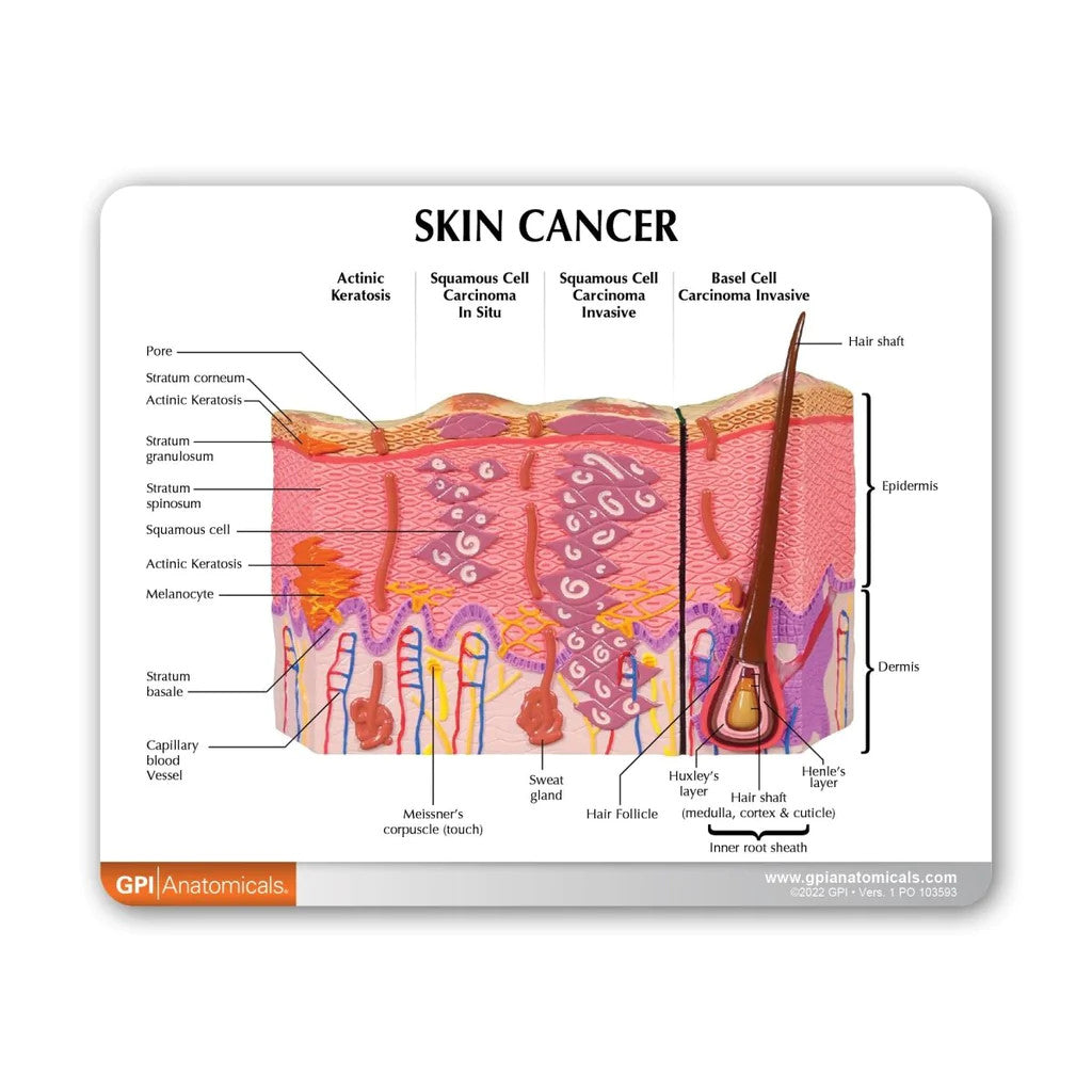 Skin Cancer Model | Dermatology Pathology Chart Model | AnatomyStuff