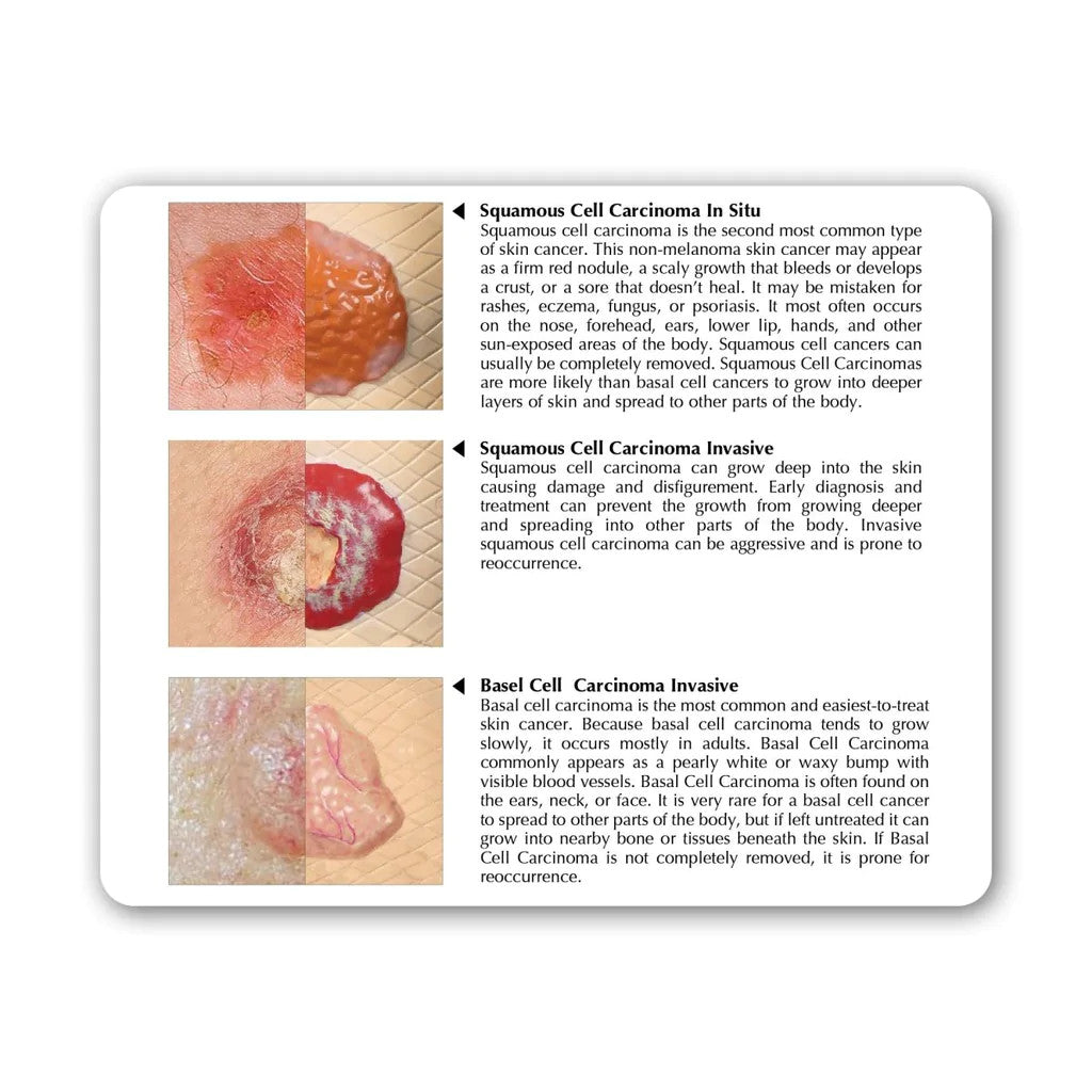 Skin Cancer Model | Dermatology Pathology Chart Model | AnatomyStuff
