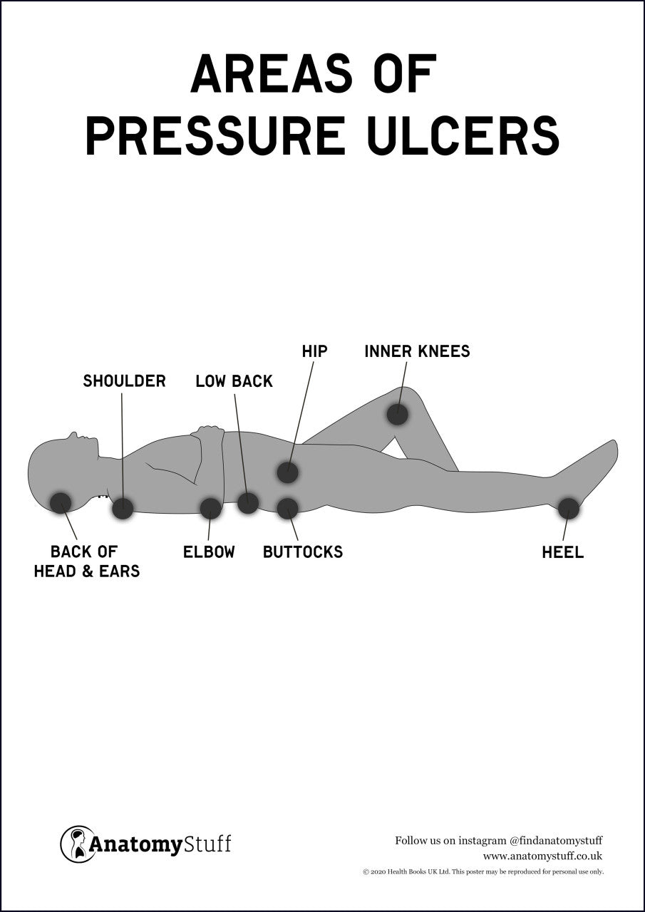 Pressure Ulcer Areas Poster PDF – AnatomyStuff