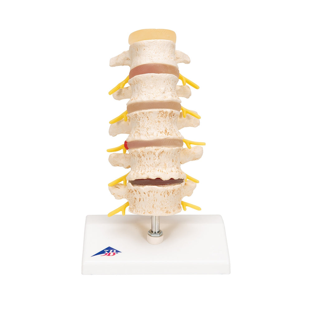 Spine Degeneration Model A795 / 1000158 | Stages of disc prolapse and ...