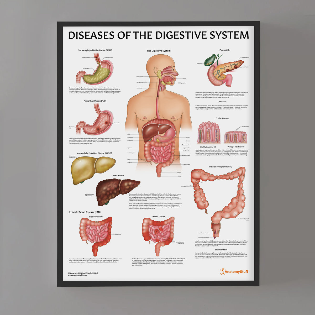 Digestive System Diseases Poster | Digestive Anatomy Chart – AnatomyStuff