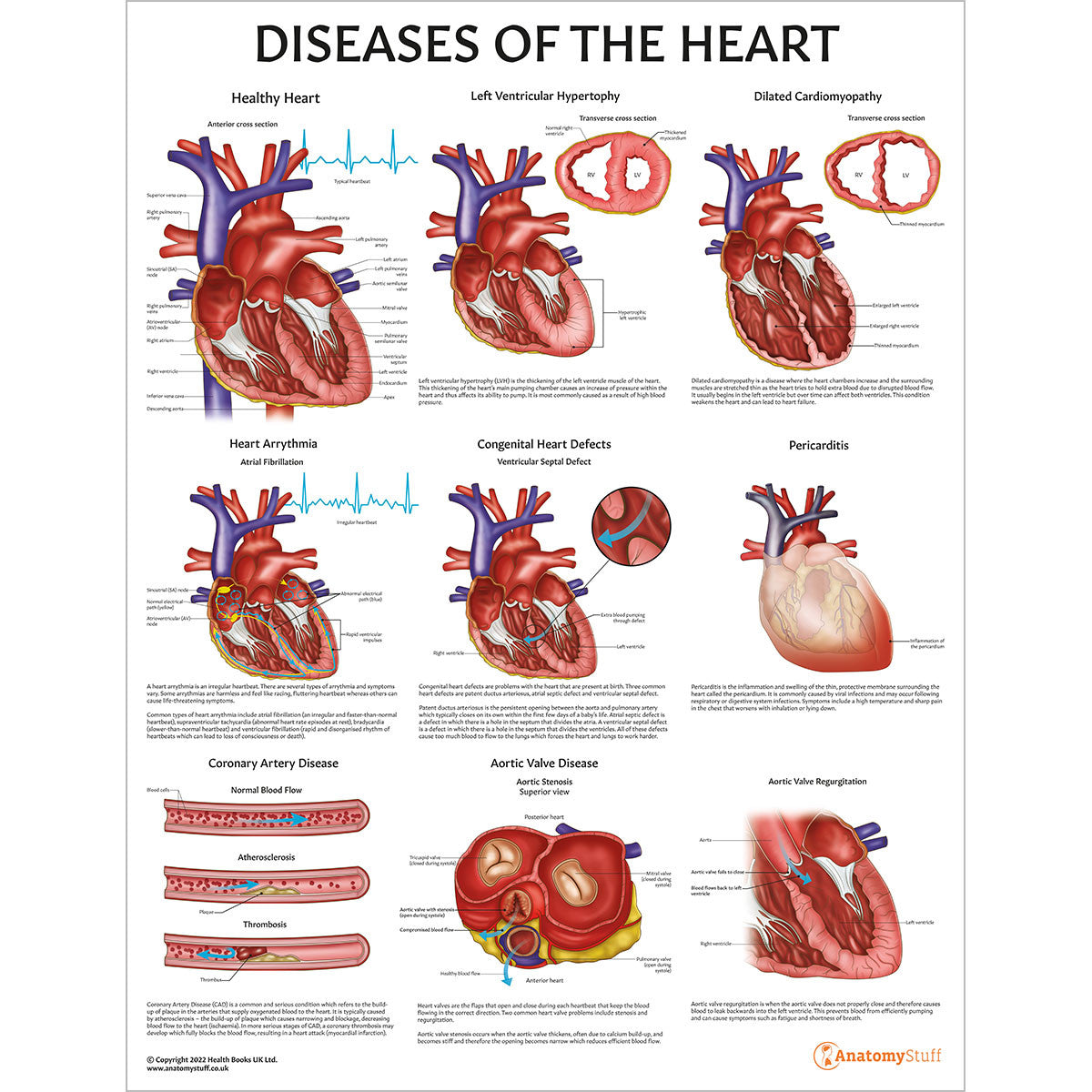 Heart Anatomy & Pathology Collection | Cardiac Disease Models Charts ...