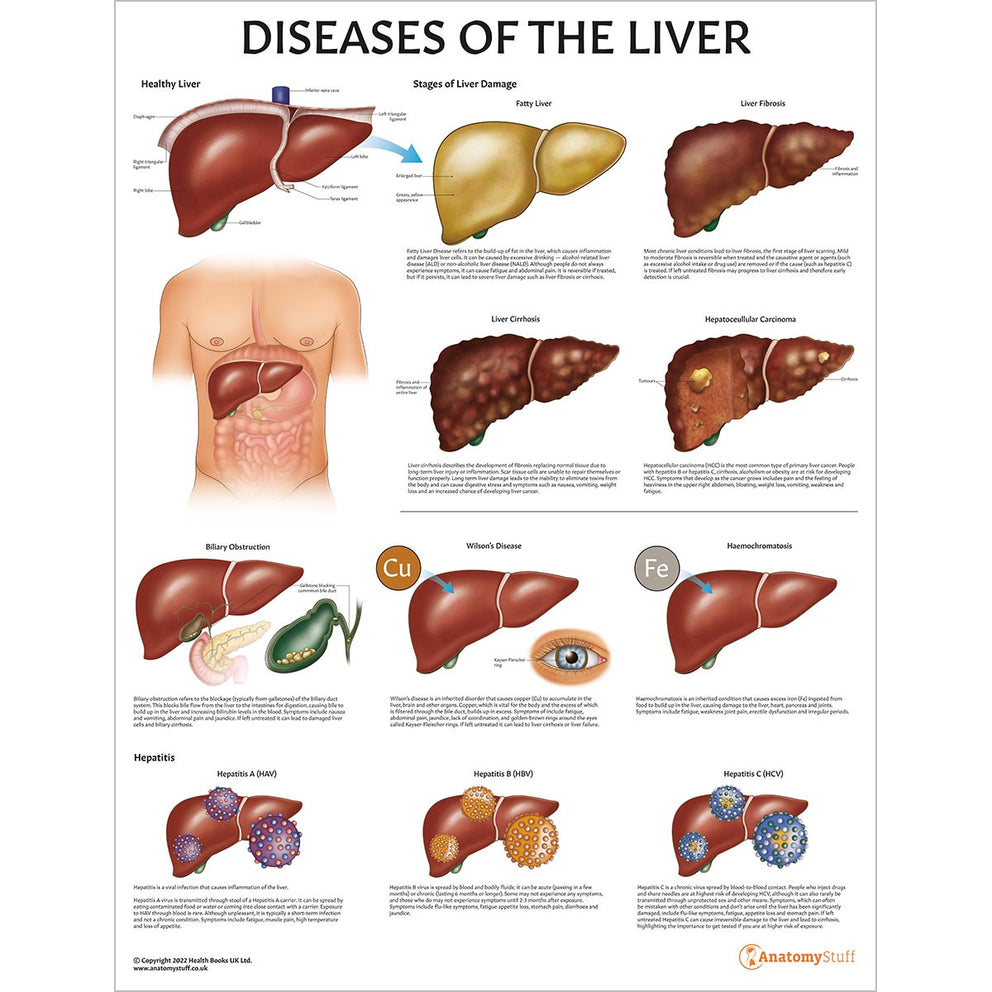 Organ Pathology Posters Collection | Diseases & Disorders – AnatomyStuff