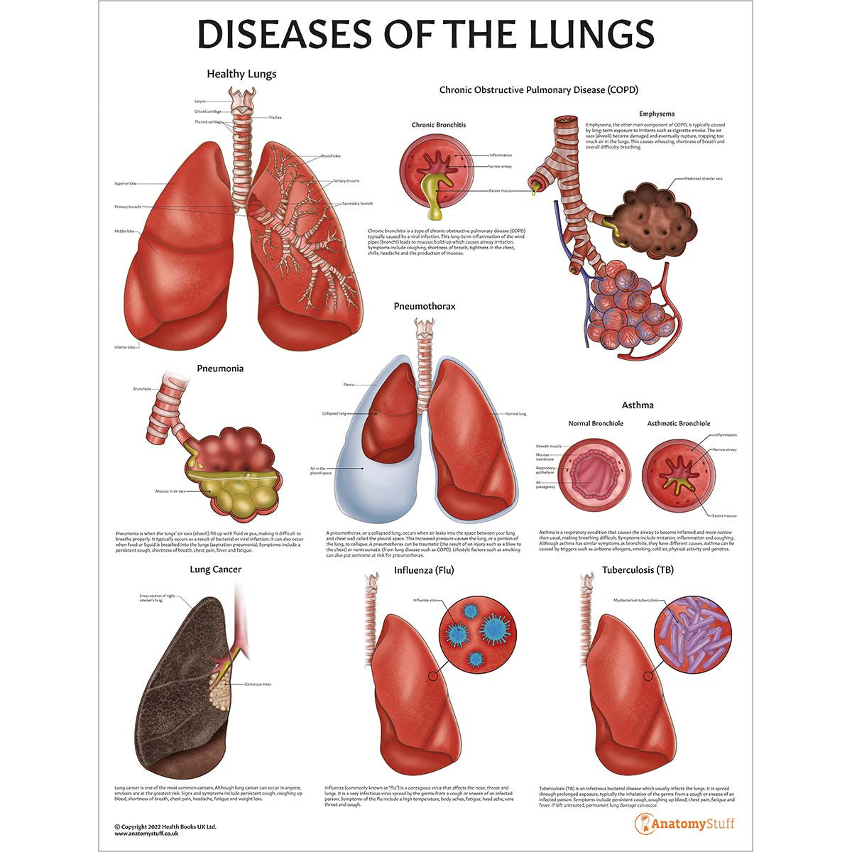 Lung Anatomy & Pathology Collection | COPD Cancer Asthma Models ...