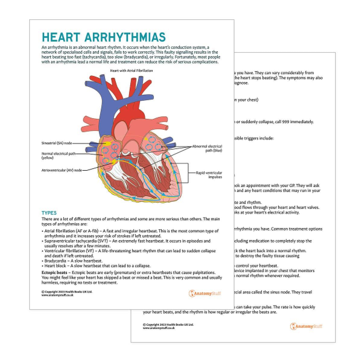 Heart Arrhythmias Patient Education Handout (Printable PDF) | AnatomyStuff