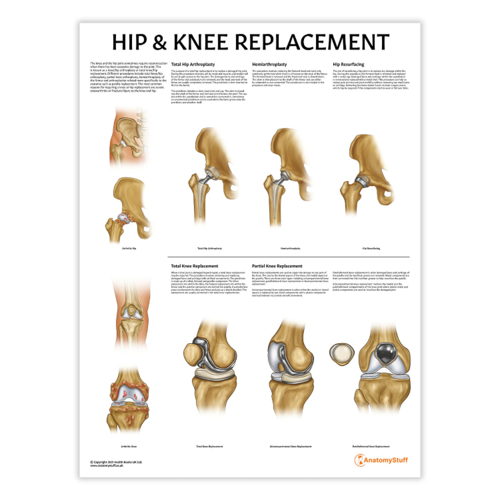 Hip & Knee Replacement Poster | Hip Knee Arthritis Pathology Chart ...