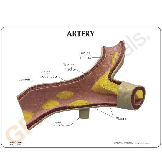 Artery Model 2600 | Cholesterol | Heart Disease | GPI Anatomicals ...