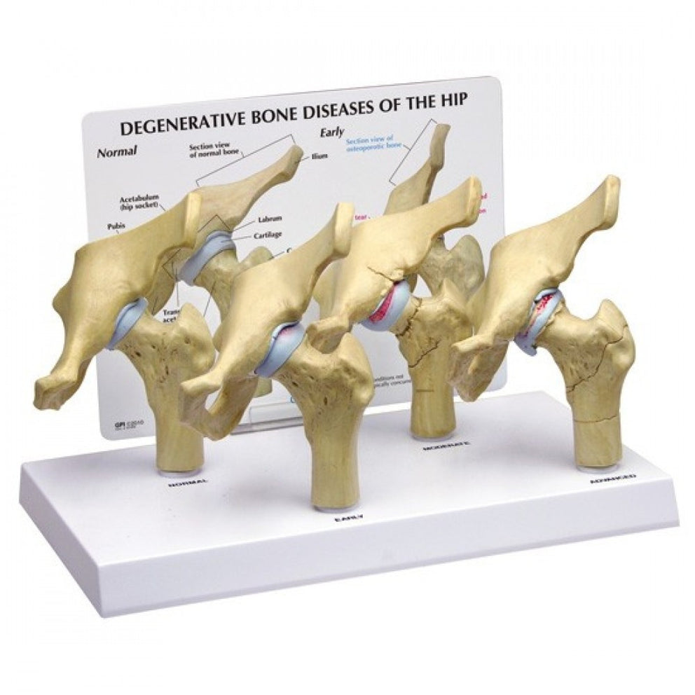 Hip Anatomy & Pathology Collection | Lower Limb Joint Models Charts ...