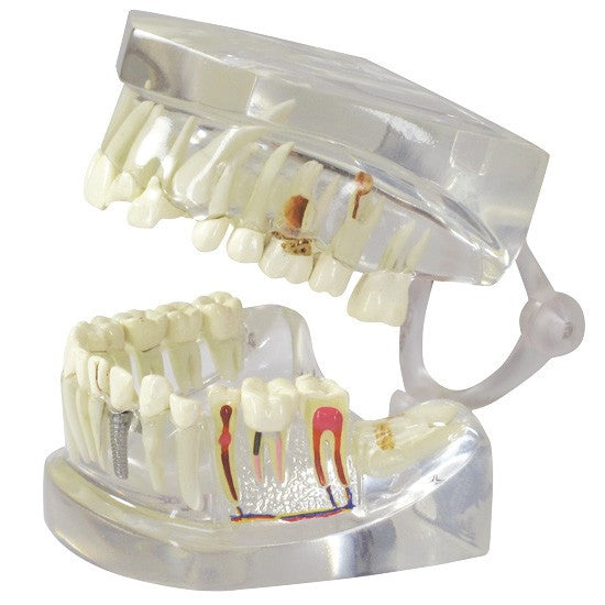 Transparent Jaw with Teeth Model 2861 | Clear Model of Human Jaw ...