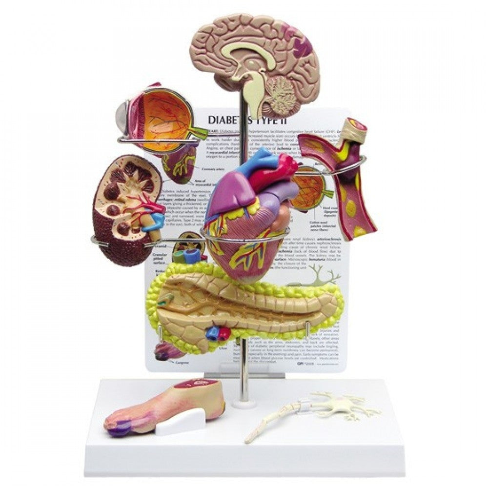 Type II Diabetes Education Collection | Glucose Insulin Models Charts ...