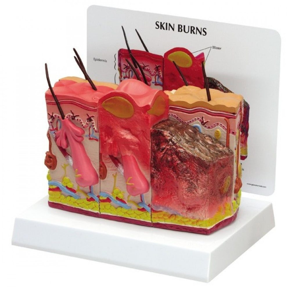Skin Anatomy & Pathology Collection | Skin Cancer Burns Acne Models ...