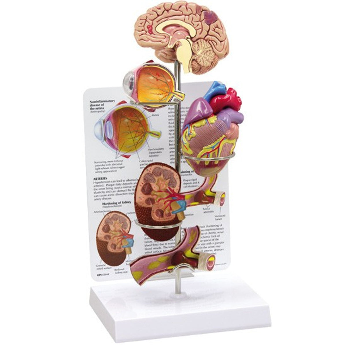 Hypertension Collection | Health Education Charts & Models Set ...