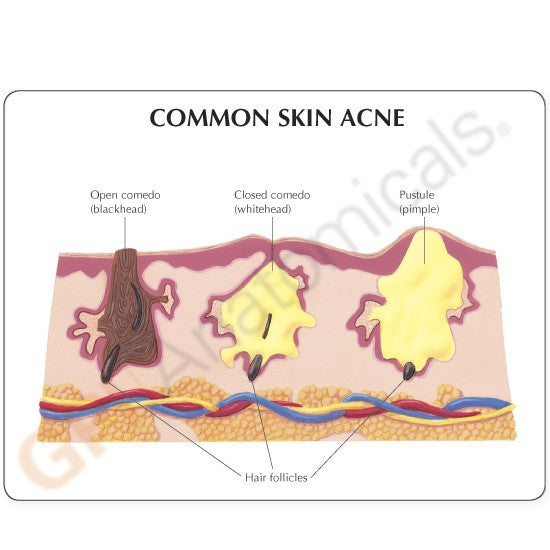 Skin Acne Model 3750 | Skin Conditions Anatomy | GPI Anatomicals ...