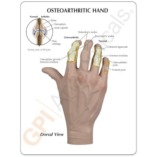 Osteoarthritis (OA) Hand Model 1930 | Finger Joints | GPI Anatomicals ...