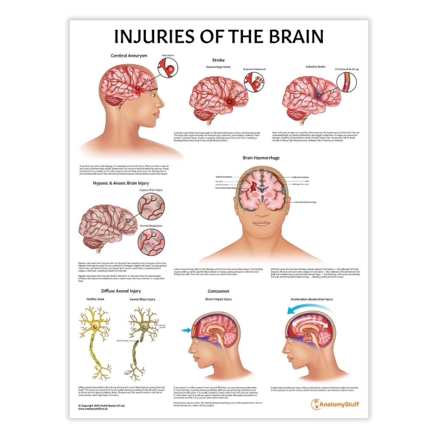 Injuries Of The Brain Chart | Brain Trauma Poster – AnatomyStuff