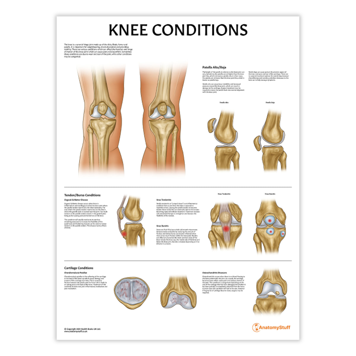 Knee Conditions Poster | Knee Pathology Chart – AnatomyStuff