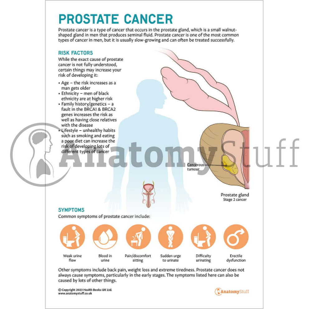 Prostate Cancer Patient Education Handout | AnatomyStuff