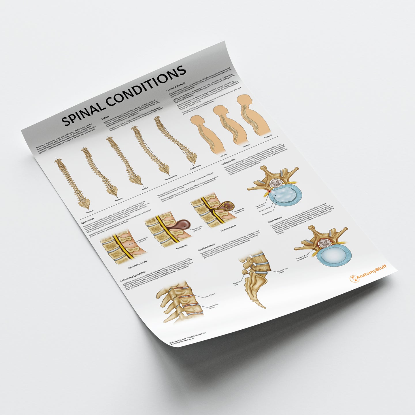 Laminated Spinal Conditions Poster | Spine Pathology Chart – AnatomyStuff