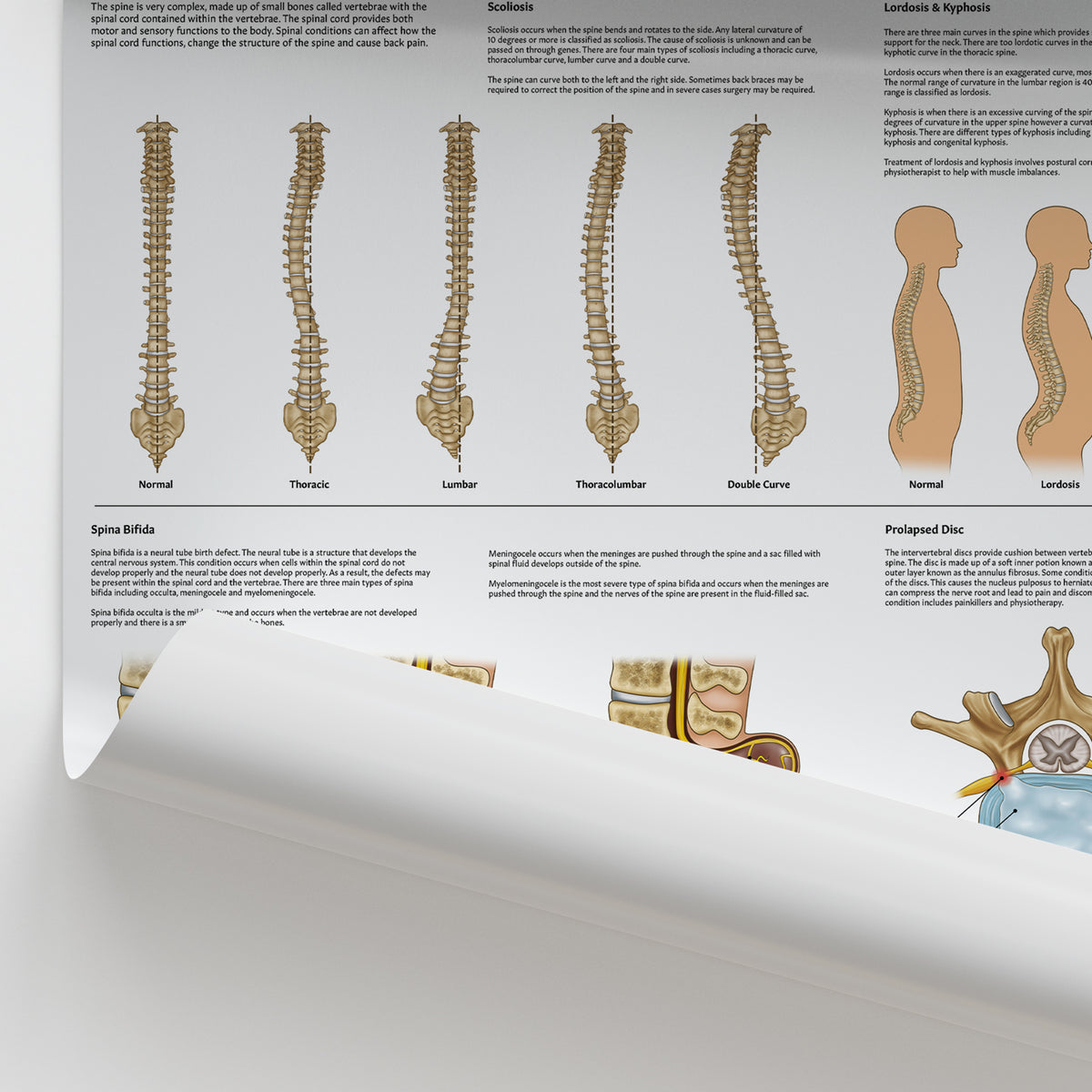 Laminated Spinal Conditions Poster | Spine Pathology Chart – AnatomyStuff