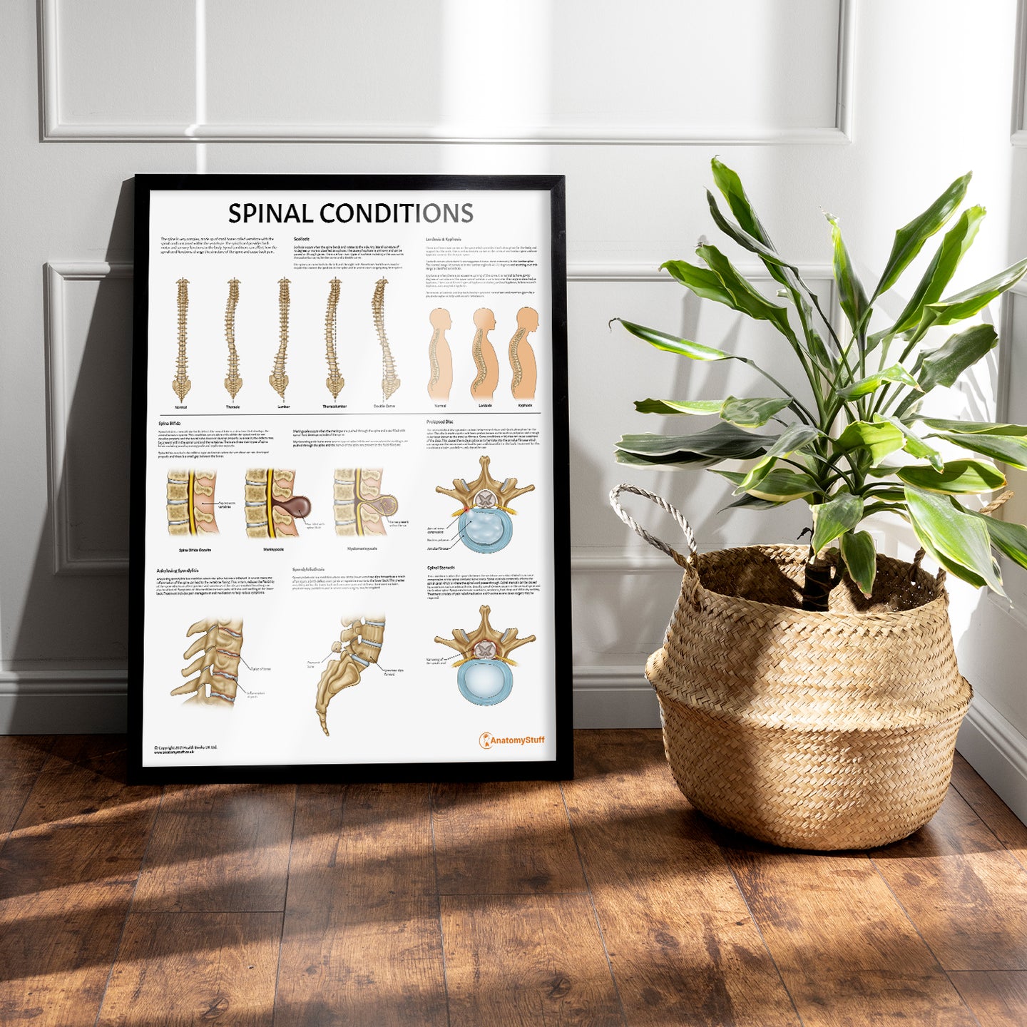 Laminated Spinal Conditions Poster | Spine Pathology Chart – AnatomyStuff