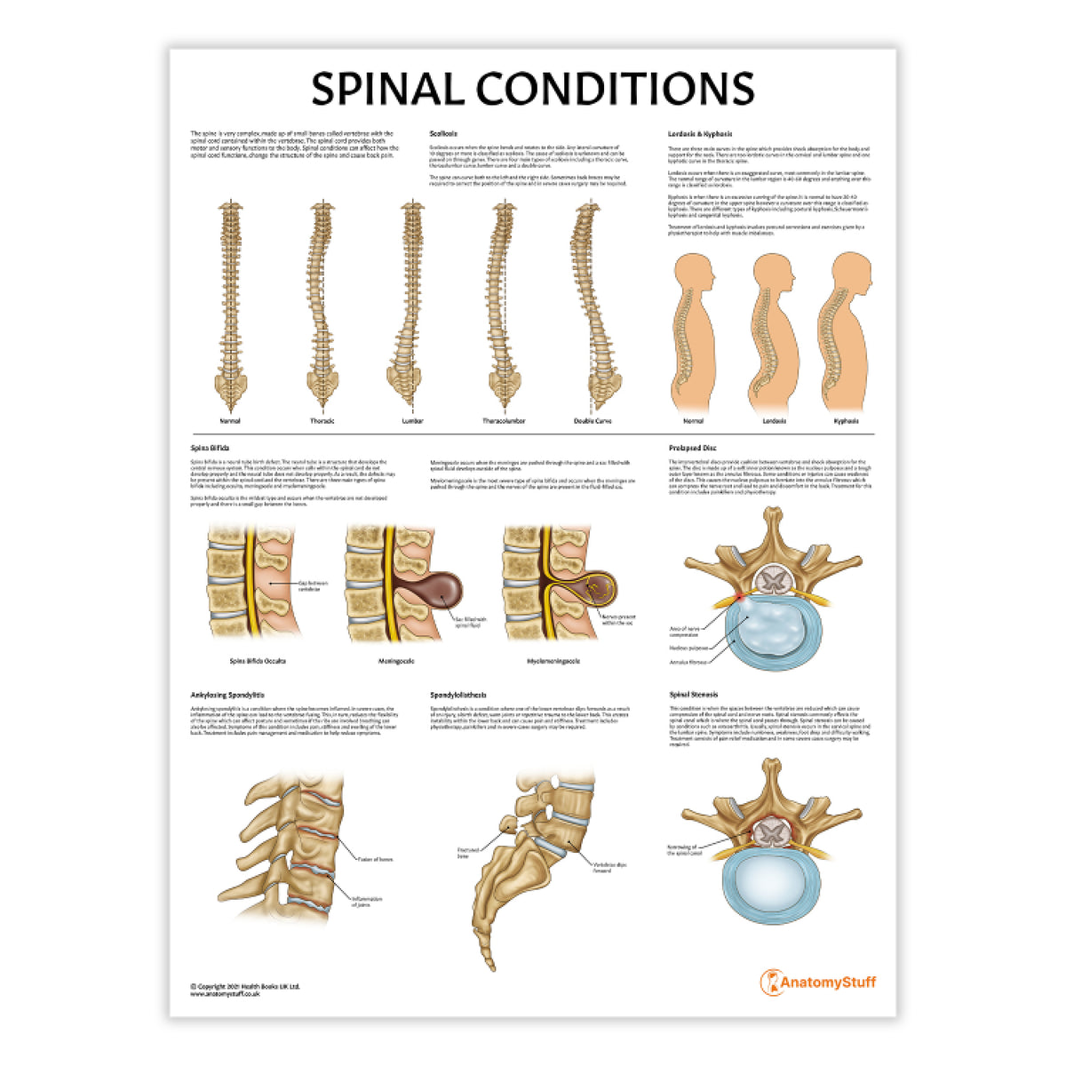 Laminated Spinal Conditions Poster | Spine Pathology Chart – AnatomyStuff