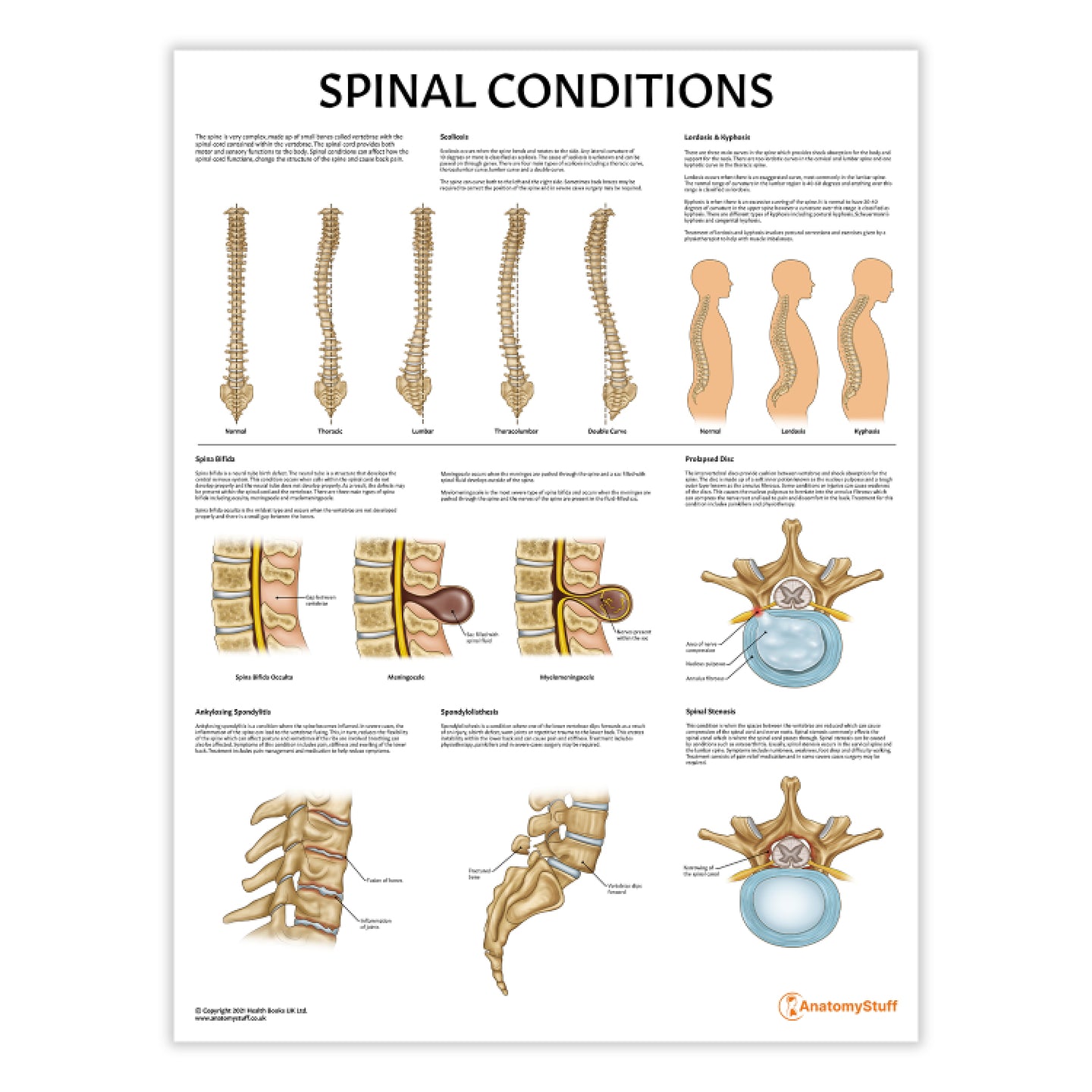 Laminated Spinal Conditions Poster | Spine Pathology Chart – AnatomyStuff