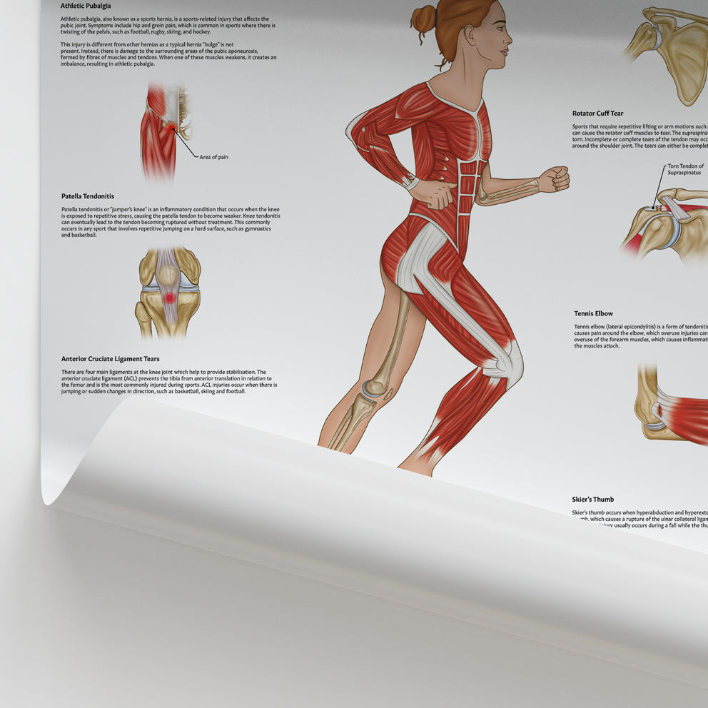 Sports Injuries Poster | Exercise Injury Dislocation Fracture Sprain ...