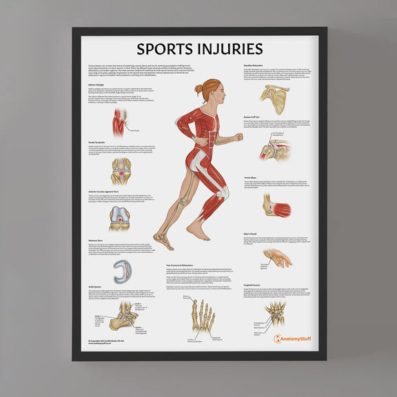 Sports Injuries Poster | Exercise Injury Dislocation Fracture Sprain ...
