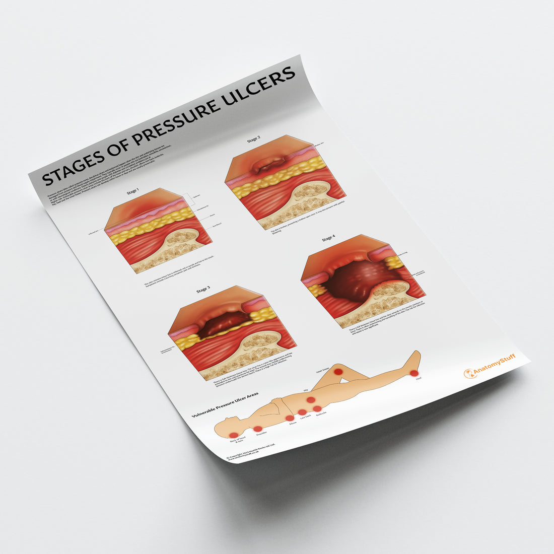 Stages Of Pressure Ulcers Chart | Bedsore Decubitus Poster – AnatomyStuff