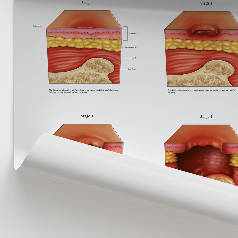 Stages Of Pressure Ulcers Chart | Bedsore Decubitus Poster – AnatomyStuff