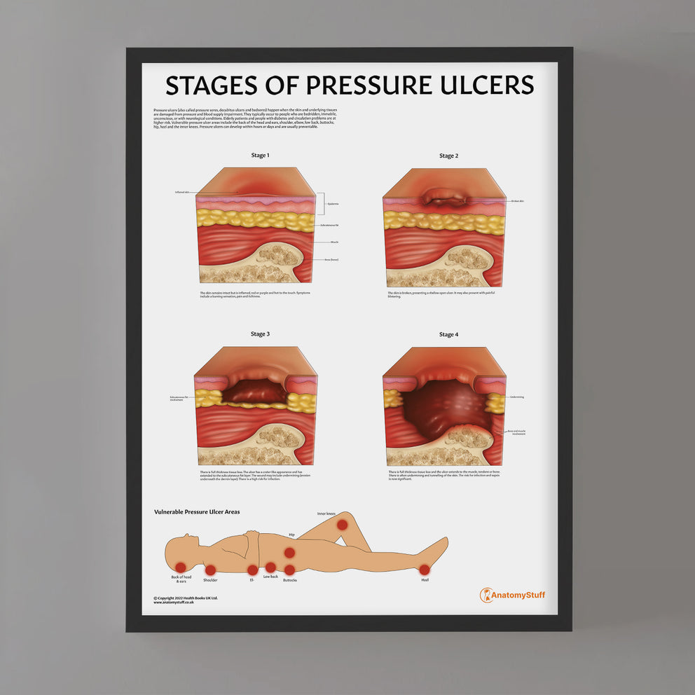 Stages Of Pressure Ulcers Chart | Bedsore Decubitus Poster – AnatomyStuff