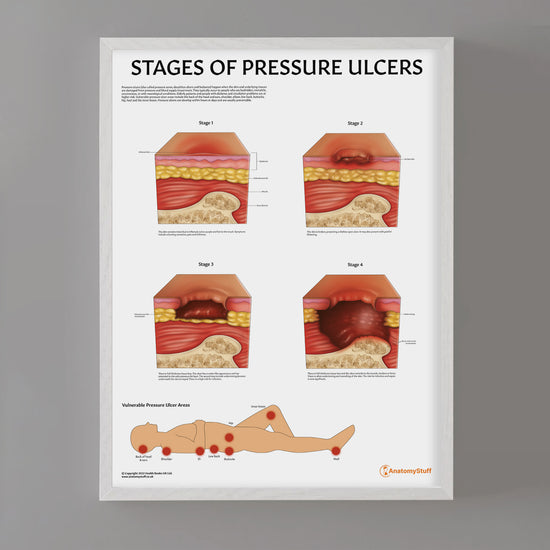 Stages Of Pressure Ulcers Chart | Bedsore Decubitus Poster – AnatomyStuff