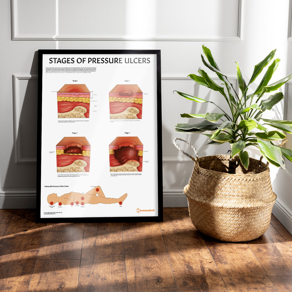 Stages Of Pressure Ulcers Chart | Bedsore Decubitus Poster – AnatomyStuff