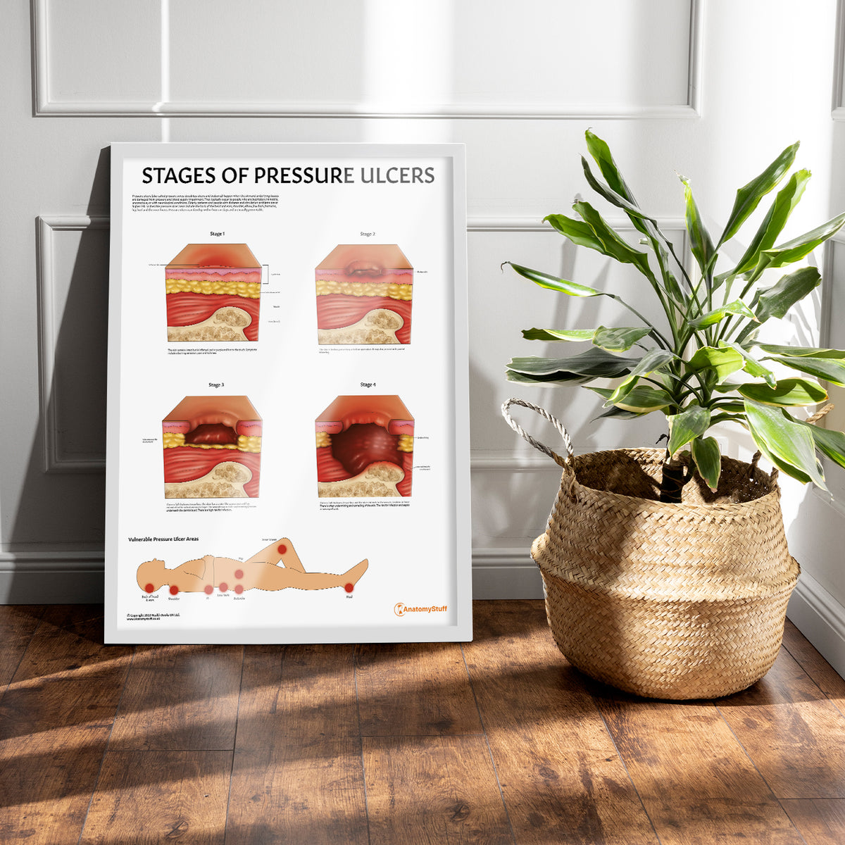 Stages Of Pressure Ulcers Chart | Bedsore Decubitus Poster – AnatomyStuff