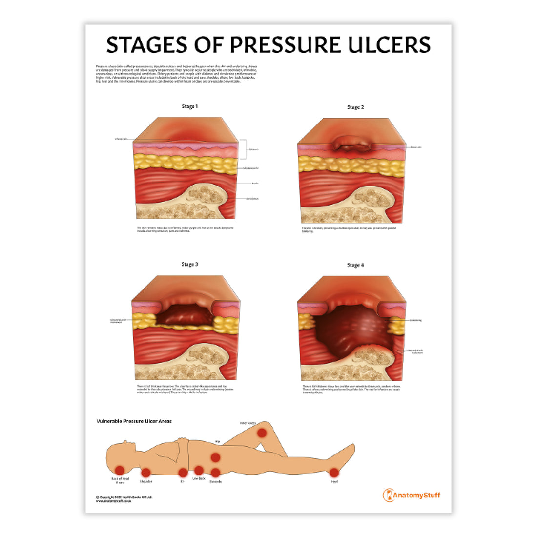 Stages Of Pressure Ulcers Chart | Bedsore Decubitus Poster – AnatomyStuff