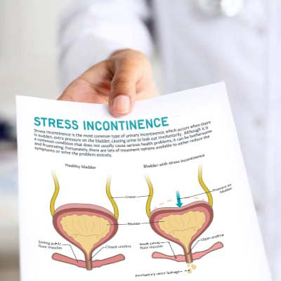 Stress Incontinence Patient Education Handout (Printable PDF ...