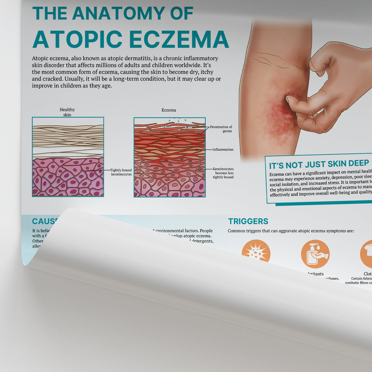 The Anatomy of Atopic Eczema Chart/Poster Laminated | Dermatology ...
