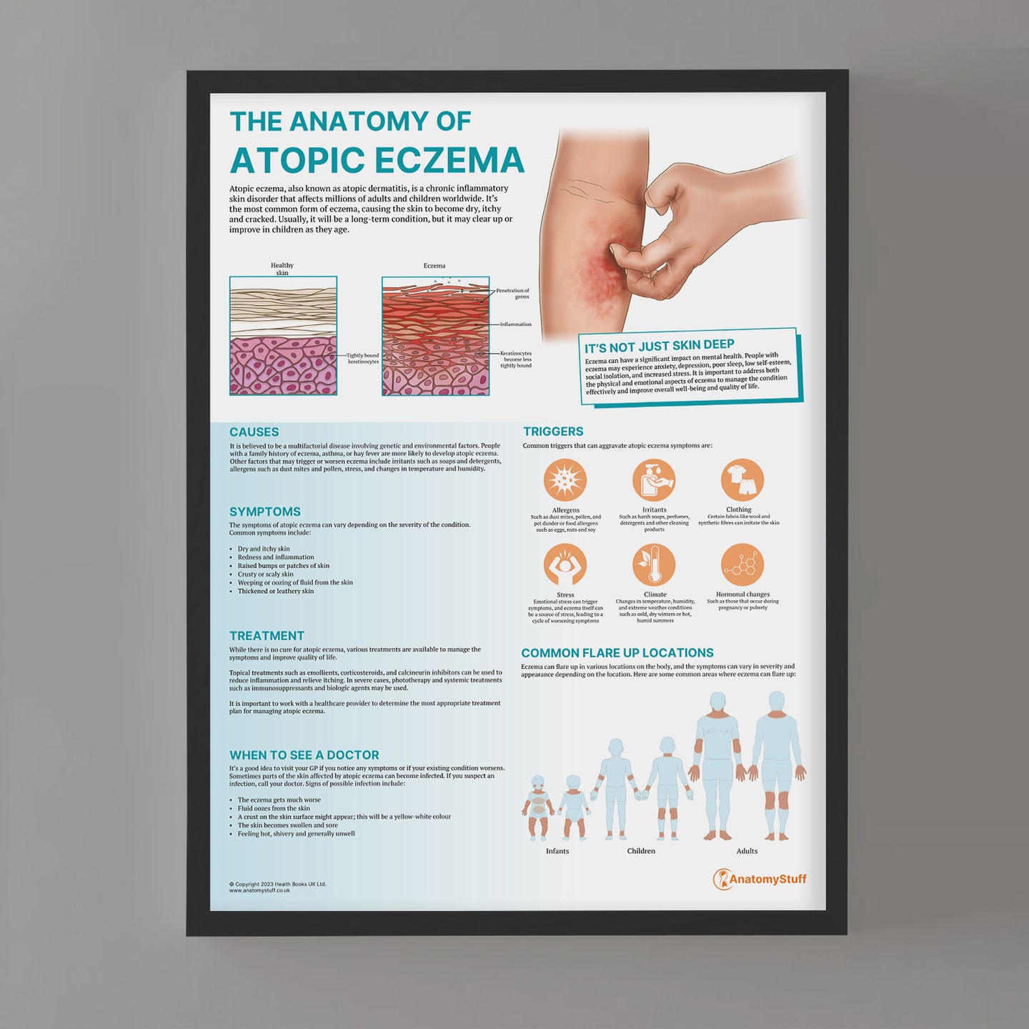 The Anatomy of Atopic Eczema Chart/Poster Laminated | Dermatology Education | AnatomyStuff