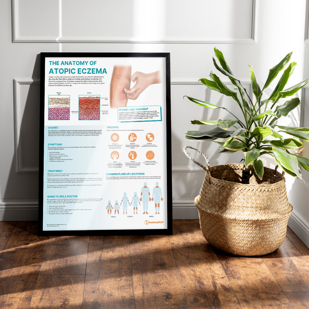 The Anatomy of Atopic Eczema Chart/Poster Laminated | Dermatology ...