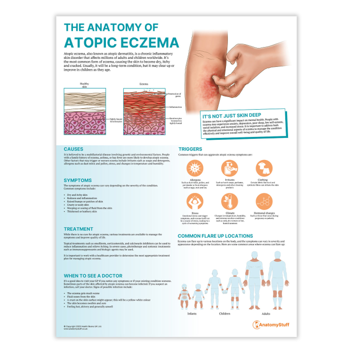 The Anatomy of Atopic Eczema Chart/Poster Laminated | Dermatology ...