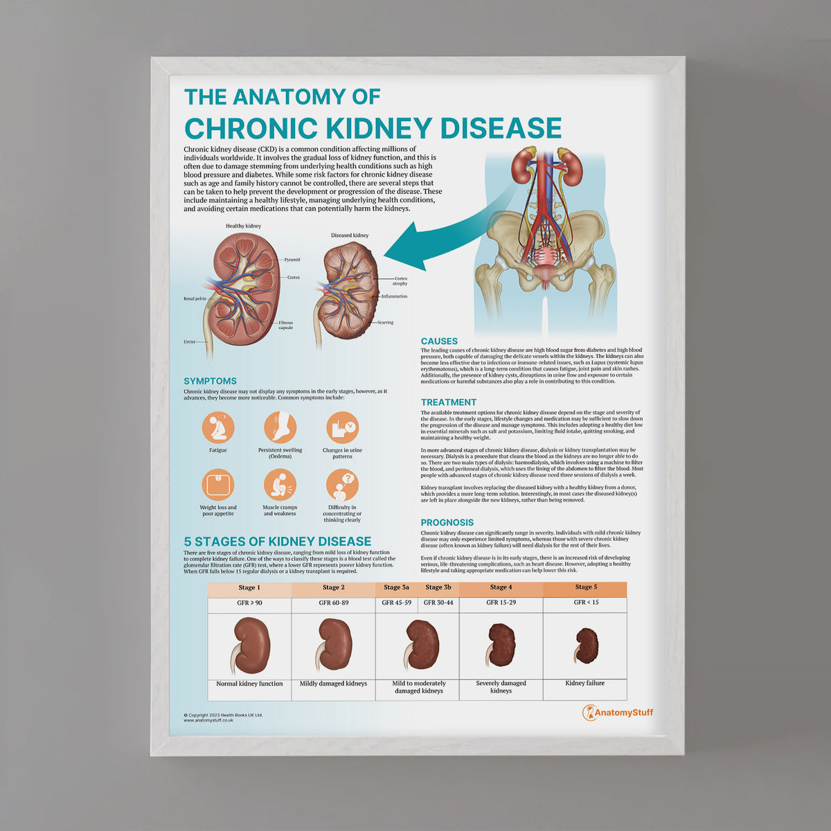 The Anatomy of Chronic Kidney Disease Chart/Poster Laminated – AnatomyStuff
