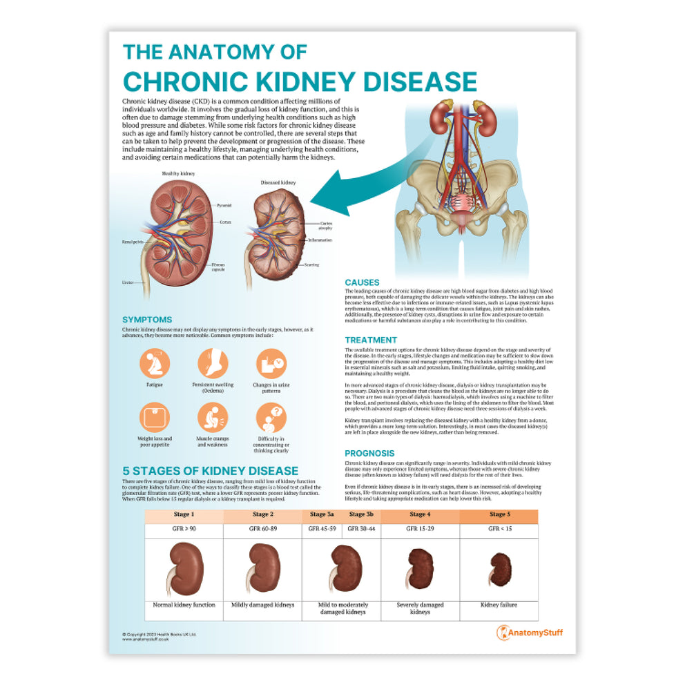 The Anatomy of Chronic Kidney Disease Chart/Poster Laminated – AnatomyStuff