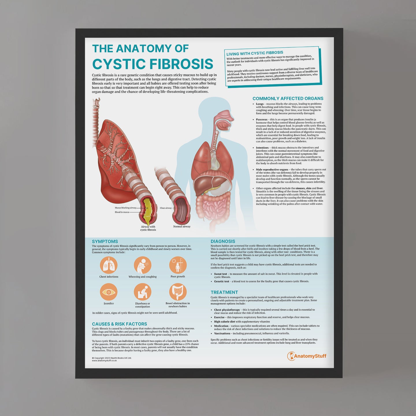 The Anatomy of Cystic Fibrosis Chart/Poster ‚Äì Laminated | Respiratory ...