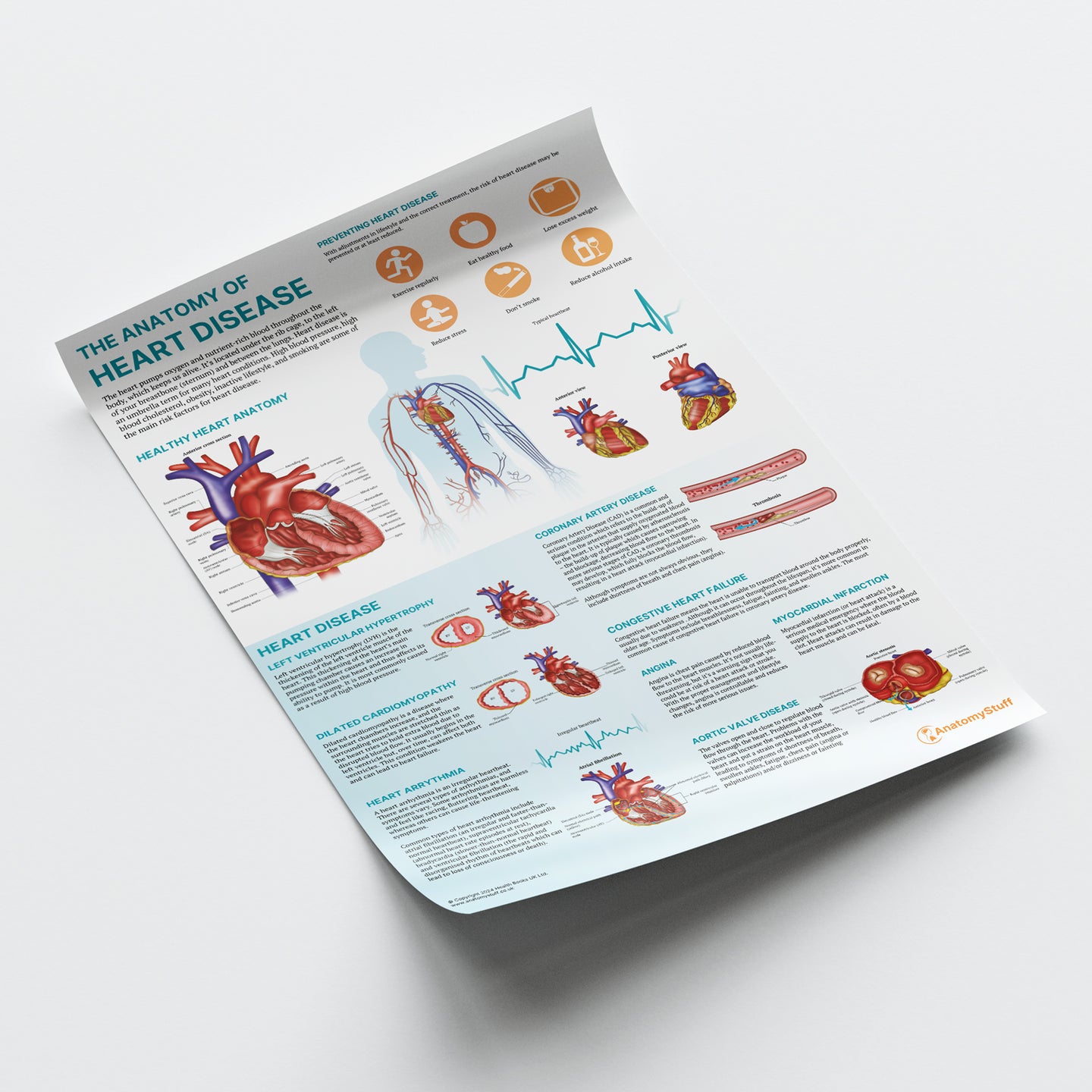 The Anatomy of Heart Disease Chart/Poster Laminated | Cardiovascular ...