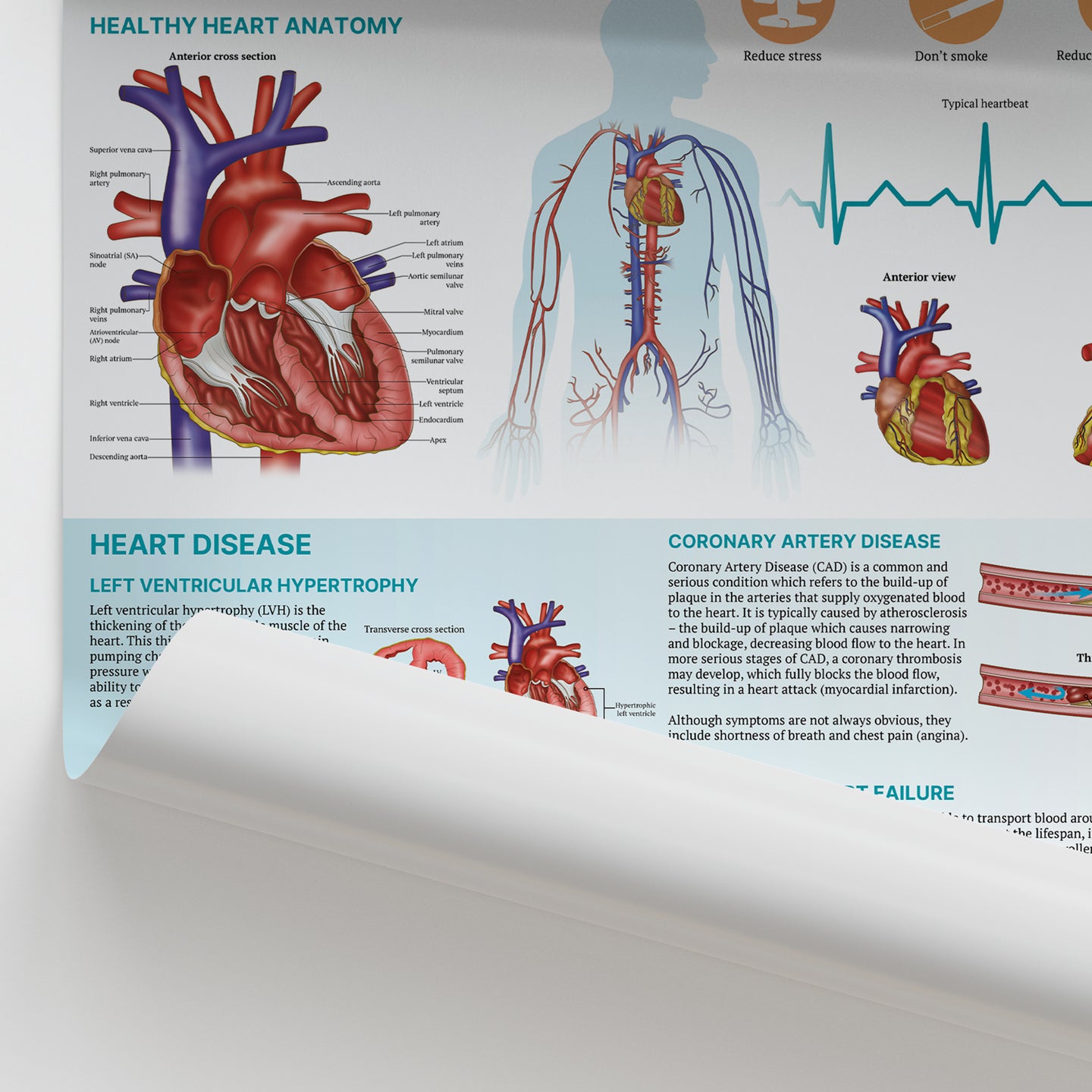 The Anatomy of Heart Disease Chart/Poster Laminated | Cardiovascular ...