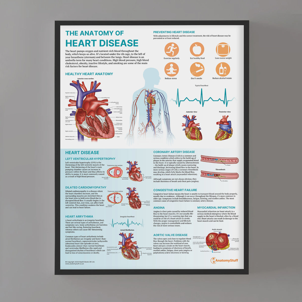 The Anatomy of Heart Disease Chart/Poster Laminated | Cardiovascular ...